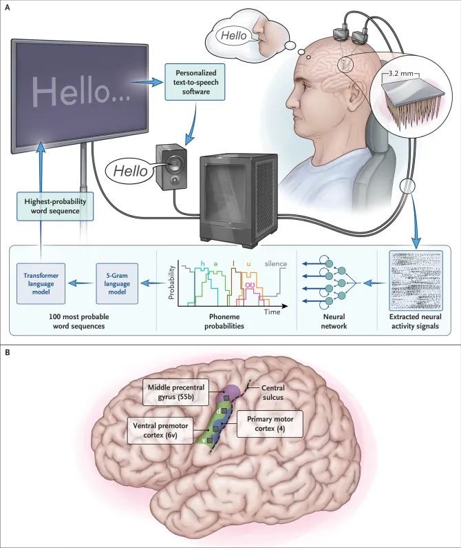 Implant mózgowy BrainGate2 pozwala sparaliżowanym mówić i śpiewać ...
